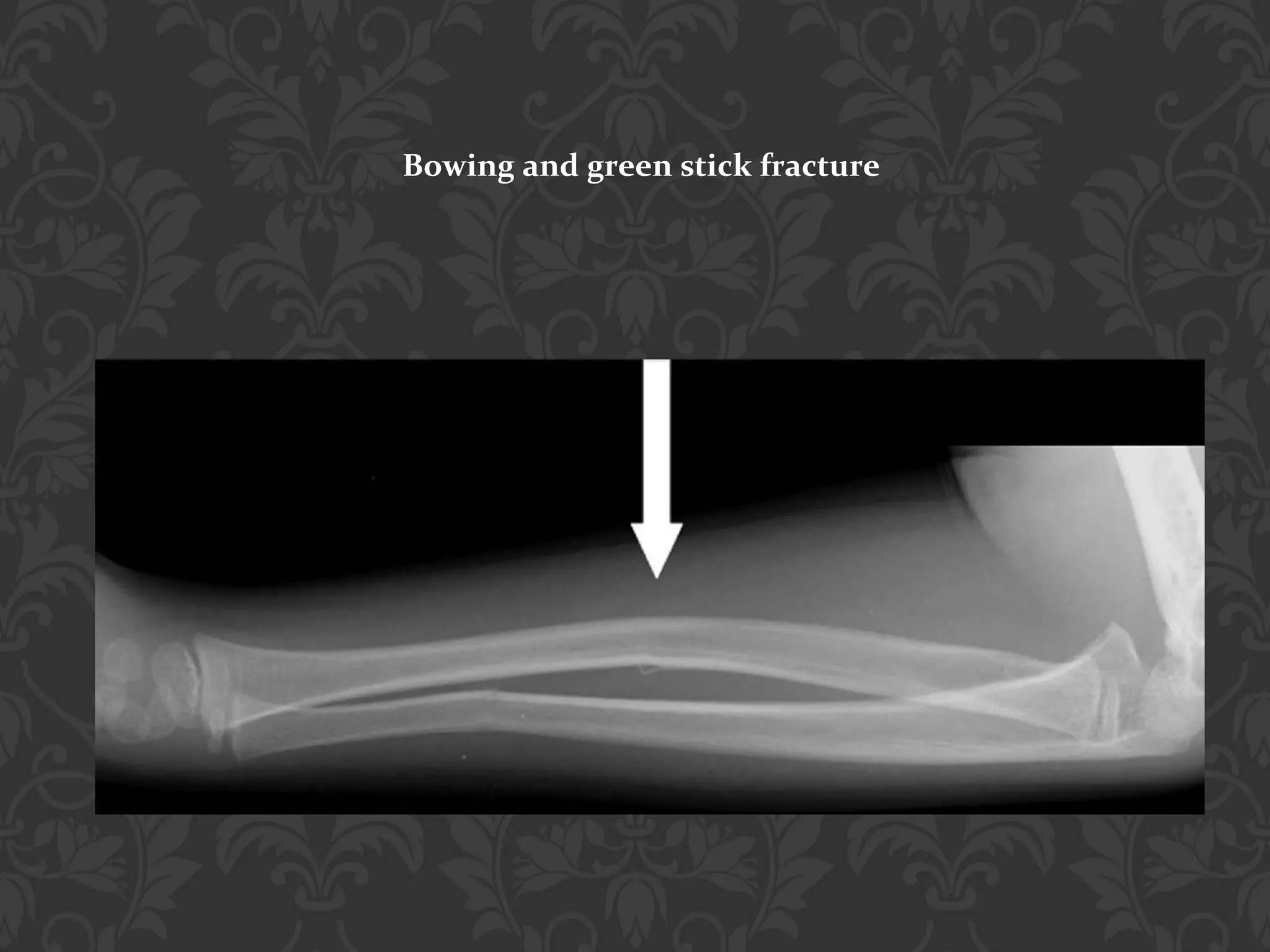 FRACTURE REPORTING TECHNIQUES FOR MEDICOS | PPT