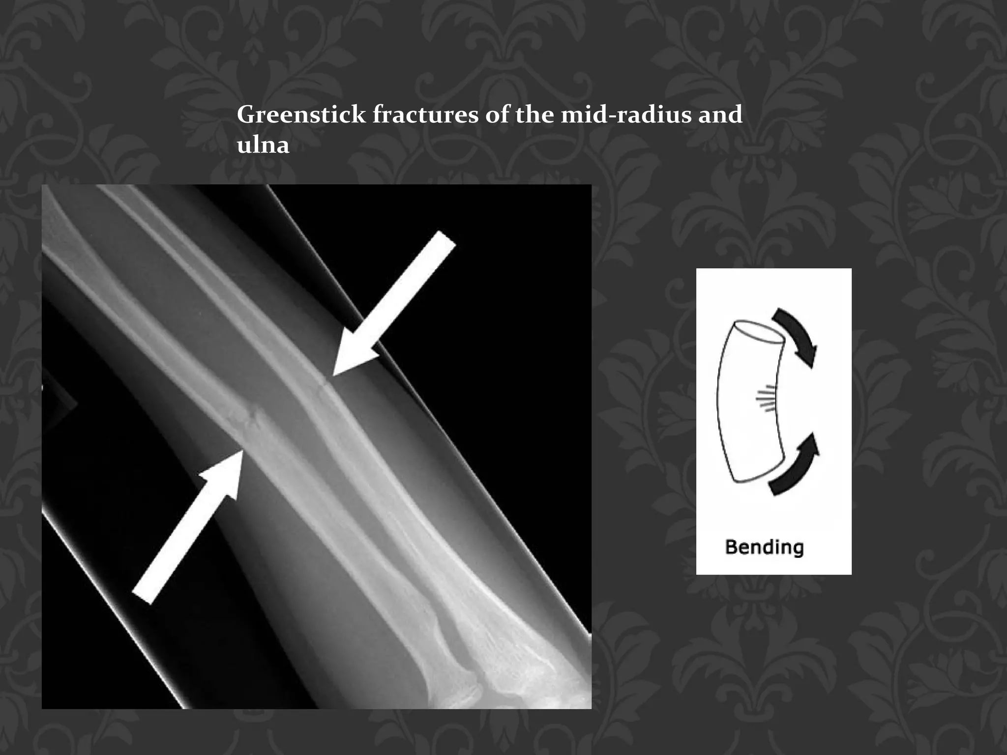 FRACTURE REPORTING TECHNIQUES FOR MEDICOS | PPT