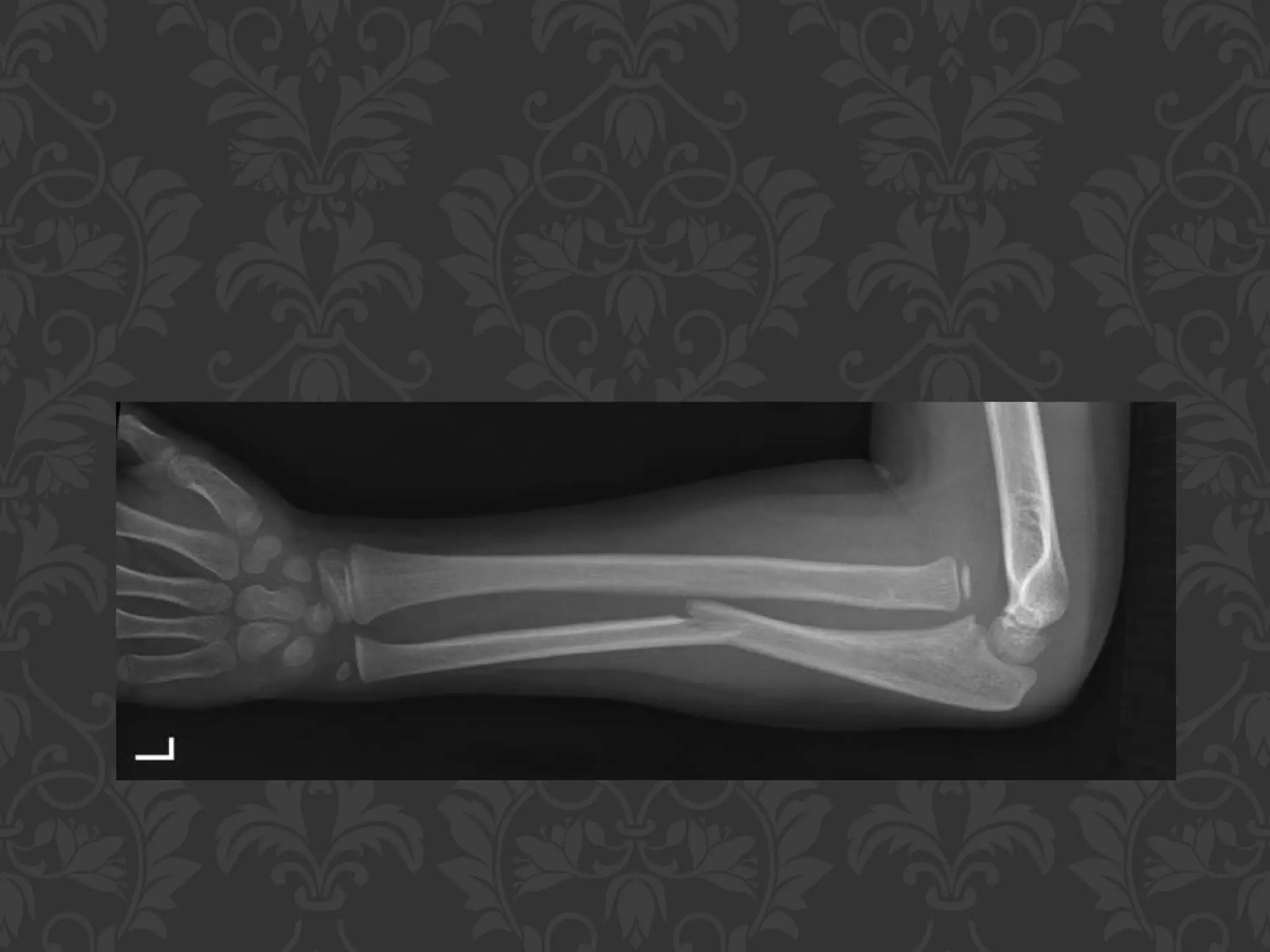 FRACTURE REPORTING TECHNIQUES FOR MEDICOS | PPT