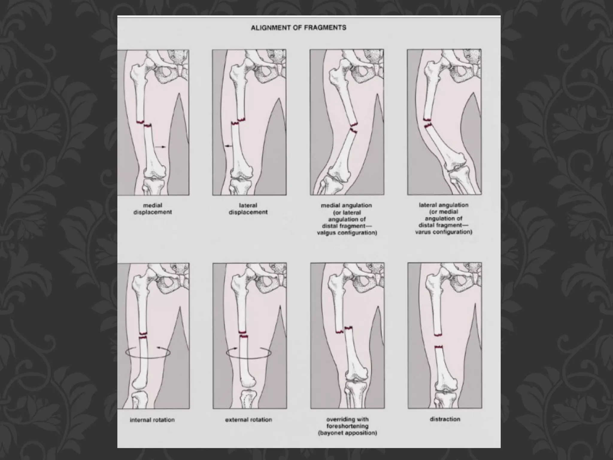 FRACTURE REPORTING TECHNIQUES FOR MEDICOS | PPT