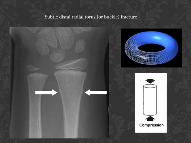 FRACTURE REPORTING TECHNIQUES FOR MEDICOS | PPT