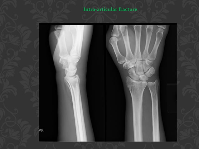 FRACTURE REPORTING TECHNIQUES FOR MEDICOS | PPT