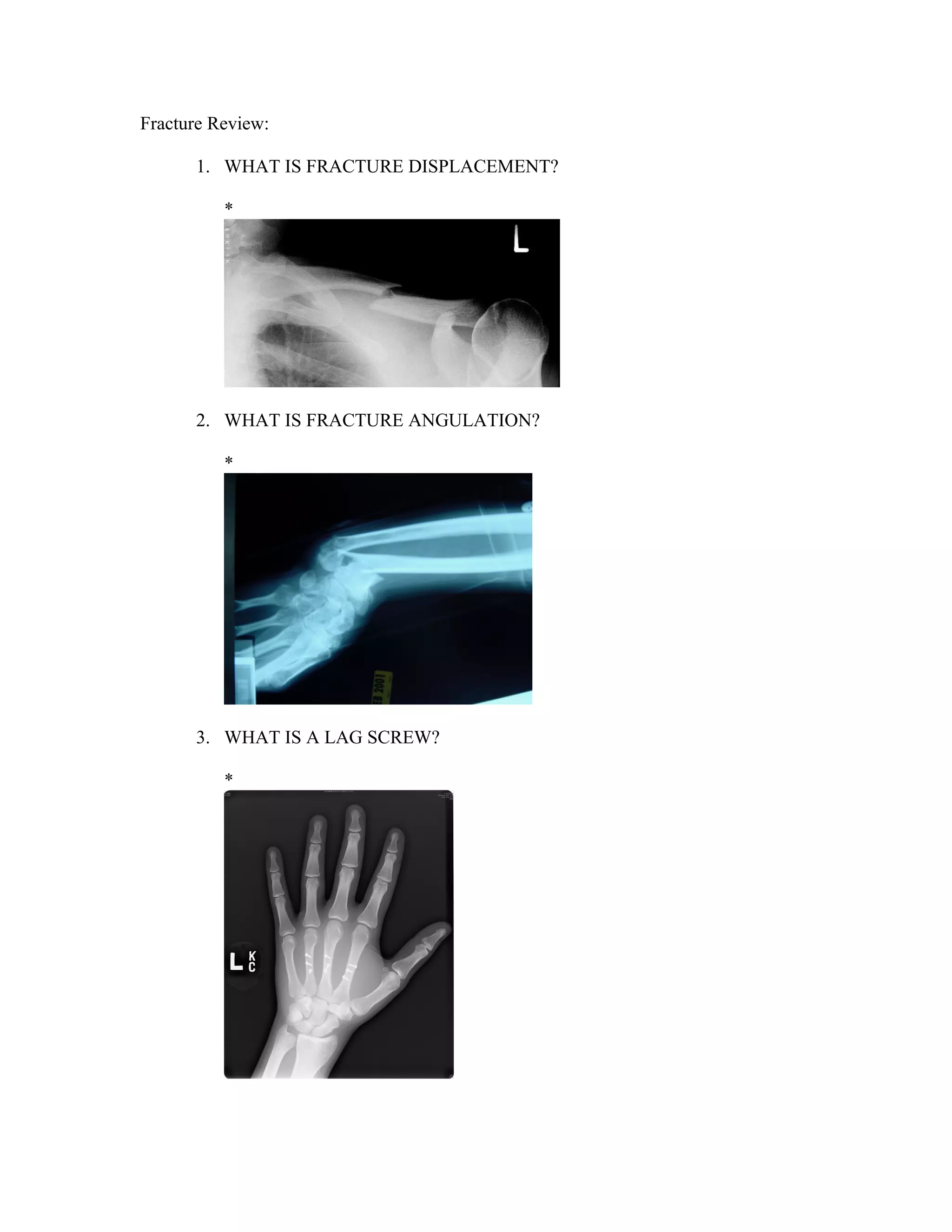 Fracture review Test | DOC