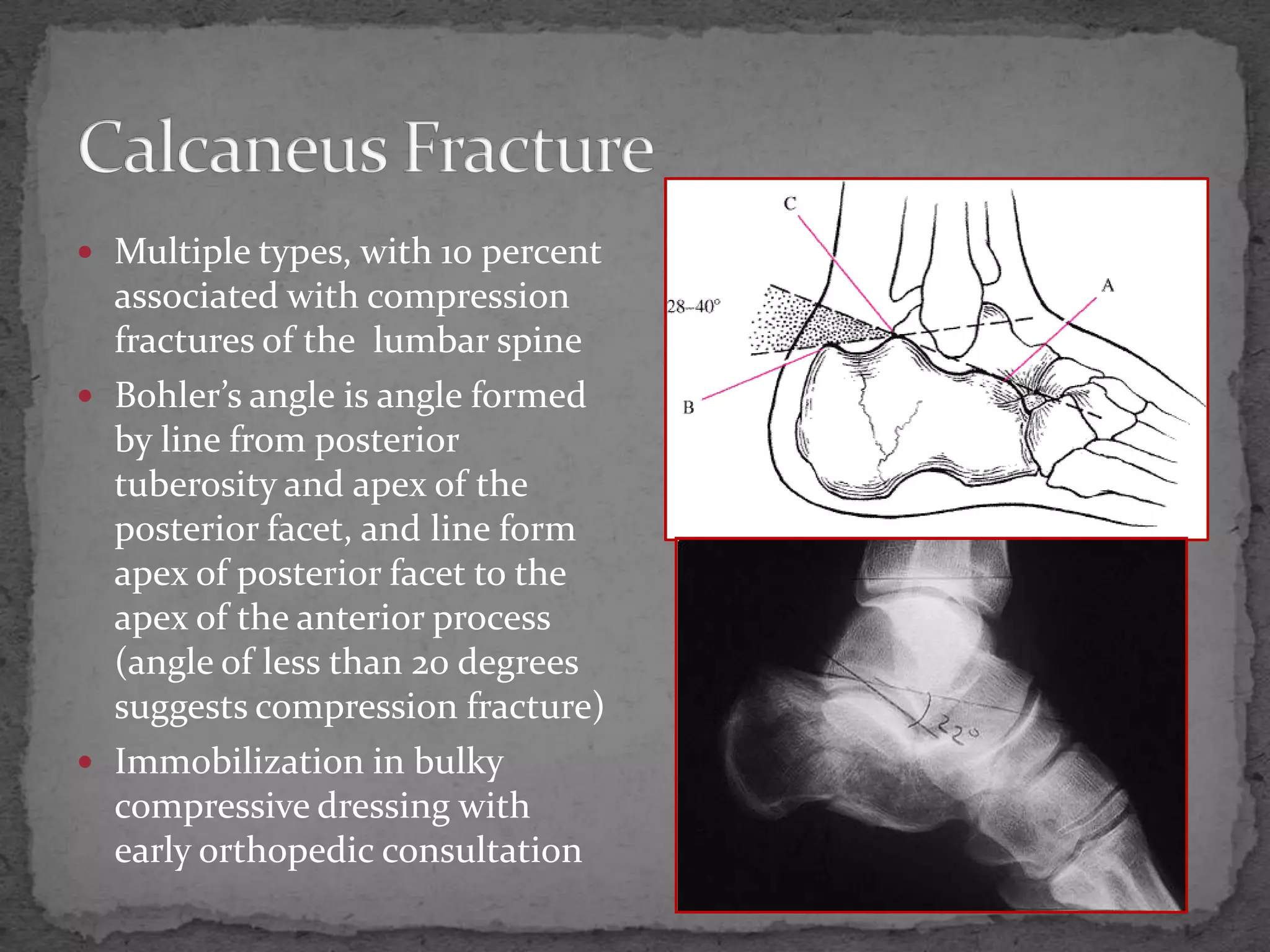 Fracture Review New Format | PPTX