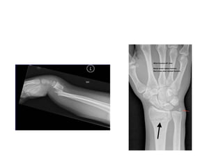 distal radius & scaphoid fracture | PPT | Death, Injury, or Military ...
