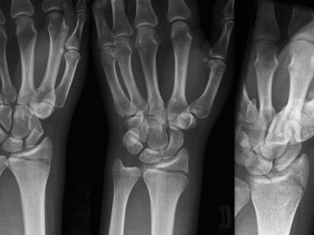 distal radius & scaphoid fracture