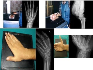 distal radius & scaphoid fracture | PPT