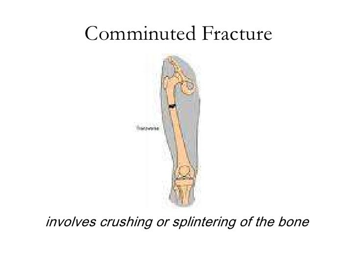 Definition of comminuted fracture - denbuilders
