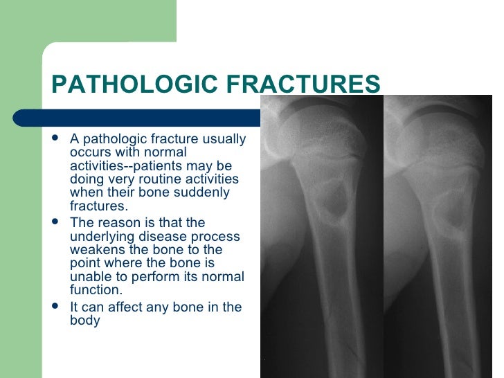 Pathological Fracture