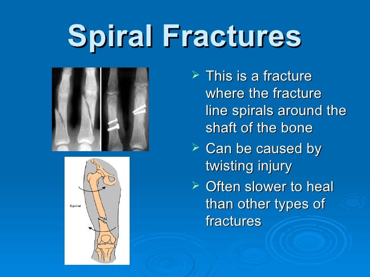 Spiral fracture causes - perustorm