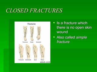 Fractures | PPT