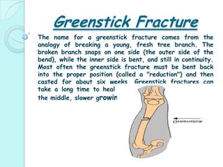 Fractures | PPT