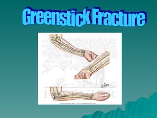 toyia's fractures | PPT