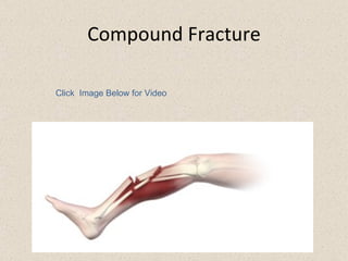 Fractures | PPT