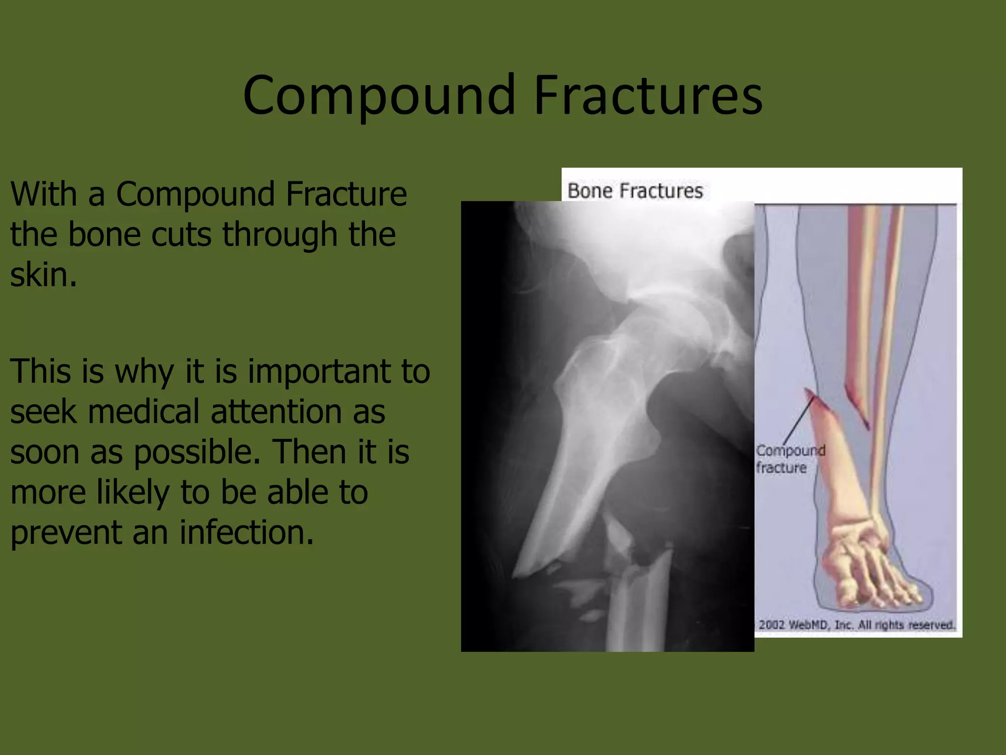 Fractures | PPTX