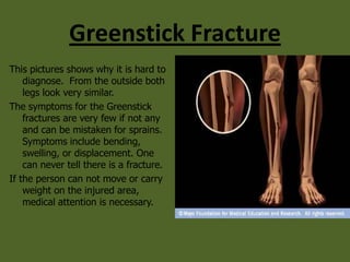 Fractures | PPTX