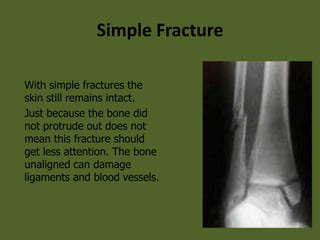 Fractures | PPTX