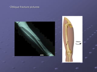 Fractures | PPTX