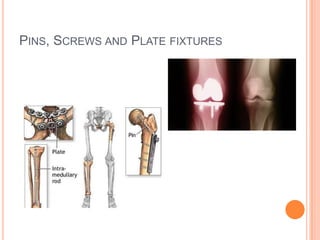 Fractures | PPTX
