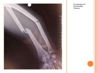 Fractures | PPTX