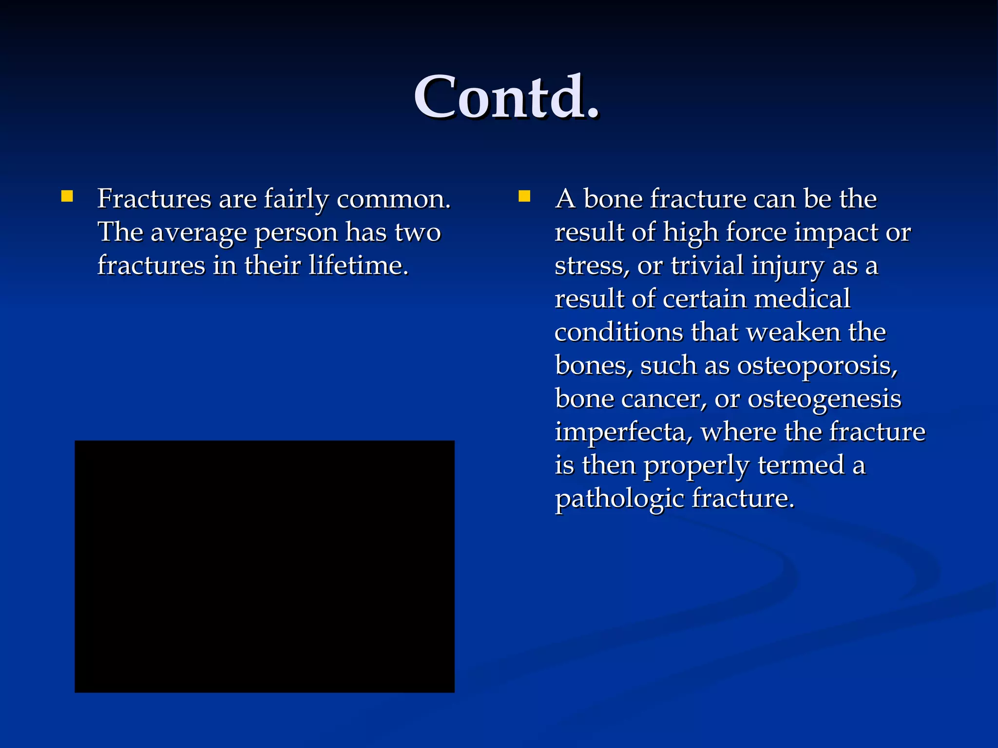 Bone Fractures | PPT