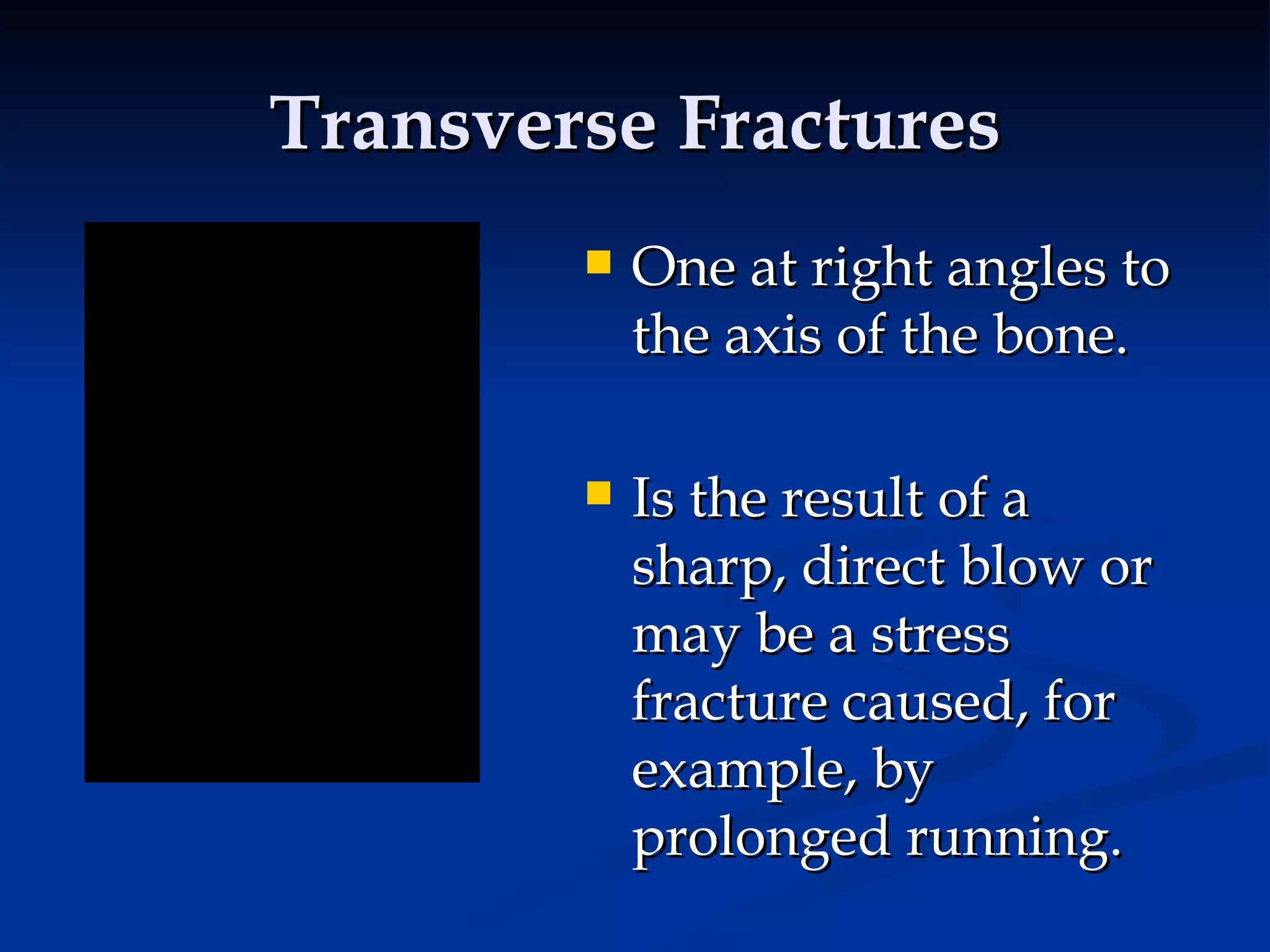 Bone Fractures | PPT