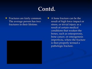 Bone Fractures | PPT