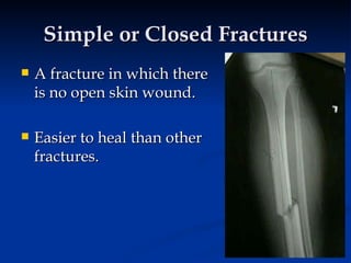Fractures | PPT