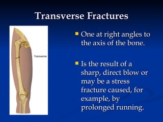 Fractures | PPT