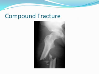 Fractures | PPT
