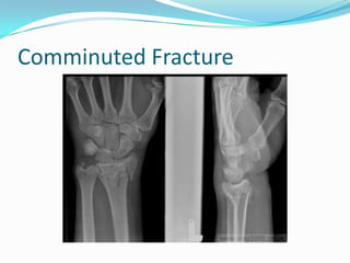 Fractures | PPT