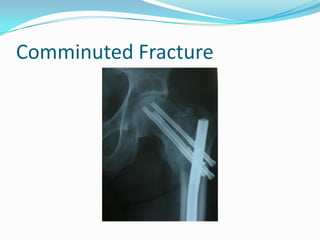Fractures | PPTX