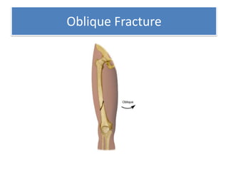 Three Types of Fractures | PPT