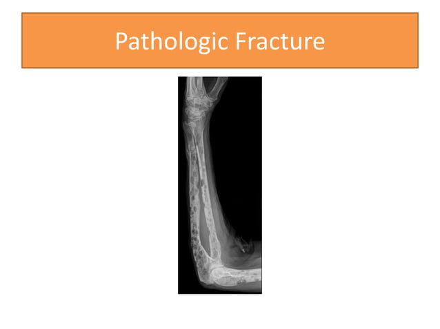 Three Types of Fractures | PPT