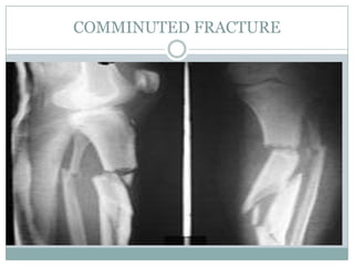 Fractures | PPT