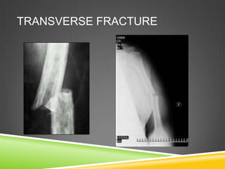 Fractures | PPTX