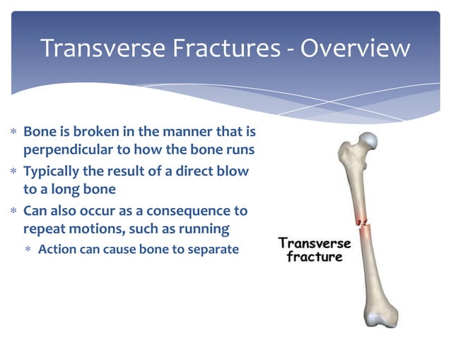 Fractures | PPT