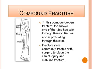 Fractures | PPT