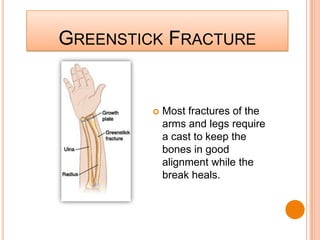 Fractures | PPT