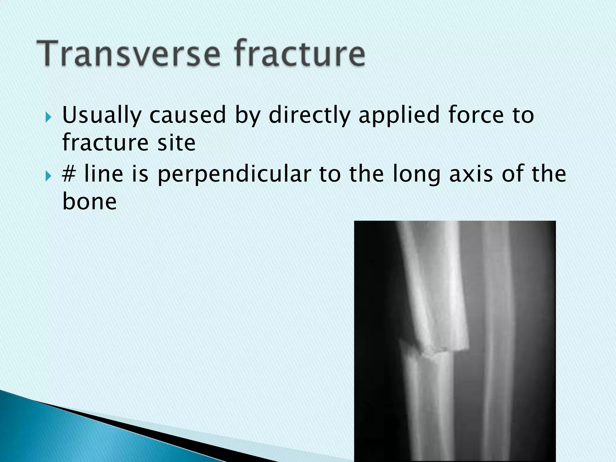 Fractures...types and healing of fractures | PPTX