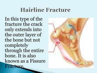 Fractures...types and healing of fractures | PPTX