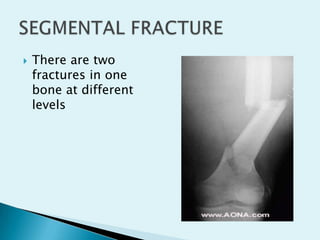 Fractures...types and healing of fractures | PPTX
