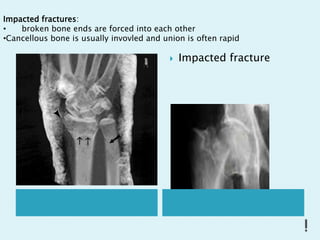 Fractures...types and healing of fractures | PPTX