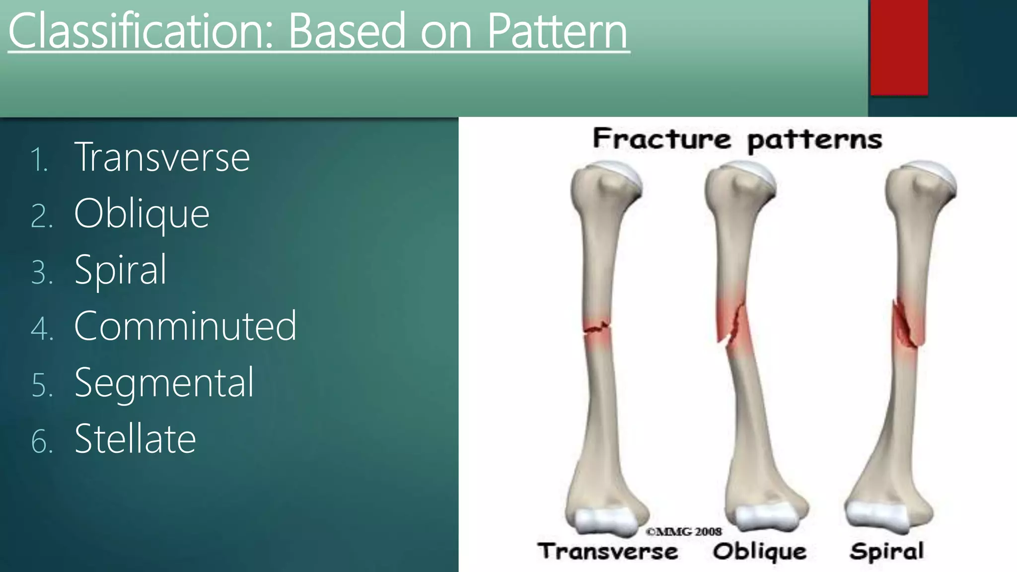 Fractures | PPTX