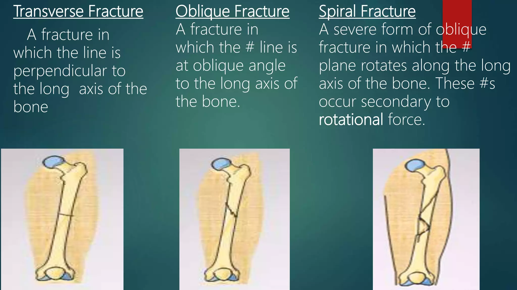 Fractures | PPTX