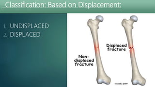 Fractures | PPTX