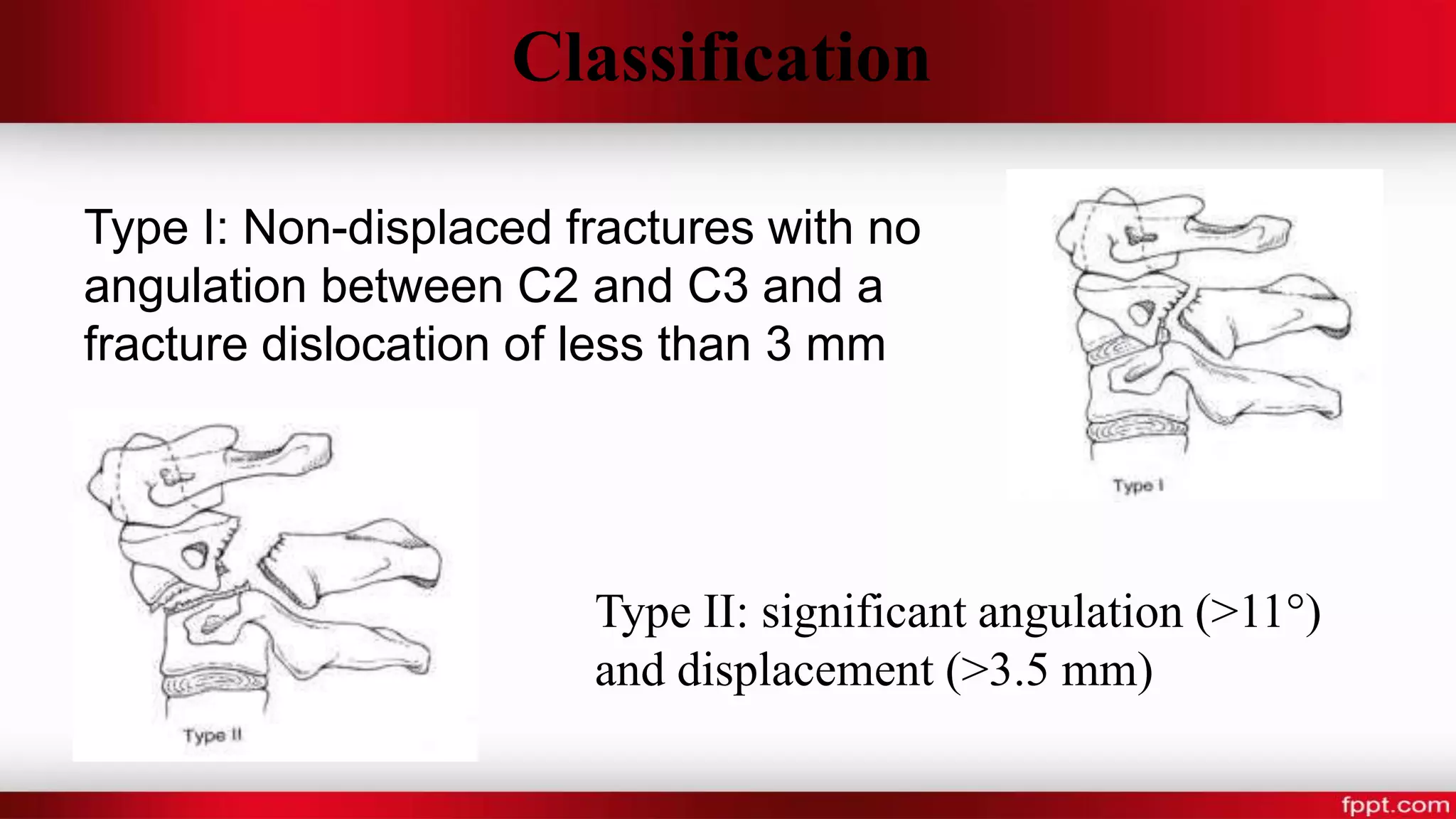 Cervical Fractures(clay shovelers,hangmans,odontoid) | PPTX