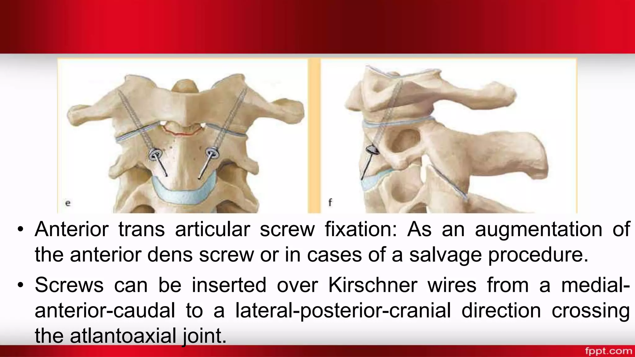 Cervical Fractures(clay shovelers,hangmans,odontoid) | PPTX