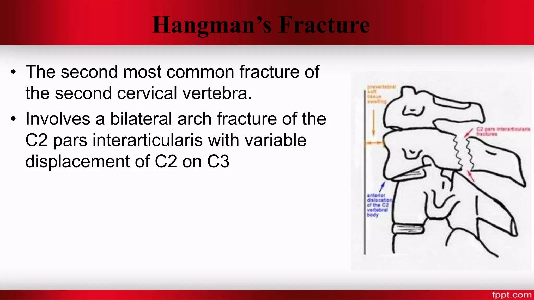 Cervical Fractures(clay shovelers,hangmans,odontoid) | PPTX