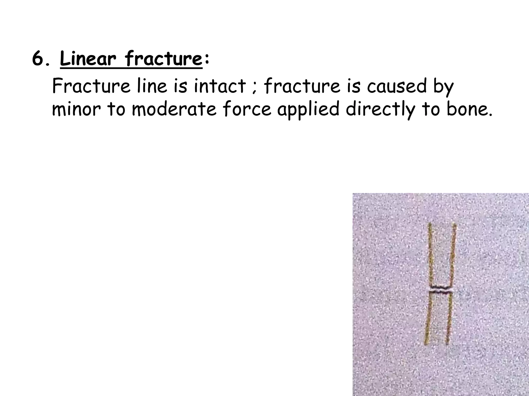 Fractures | PPTX